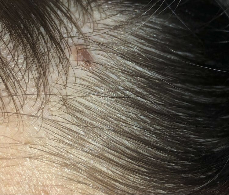 Wat is dit bruine bultje op mijn hoofdhuid? - GoeieVraag