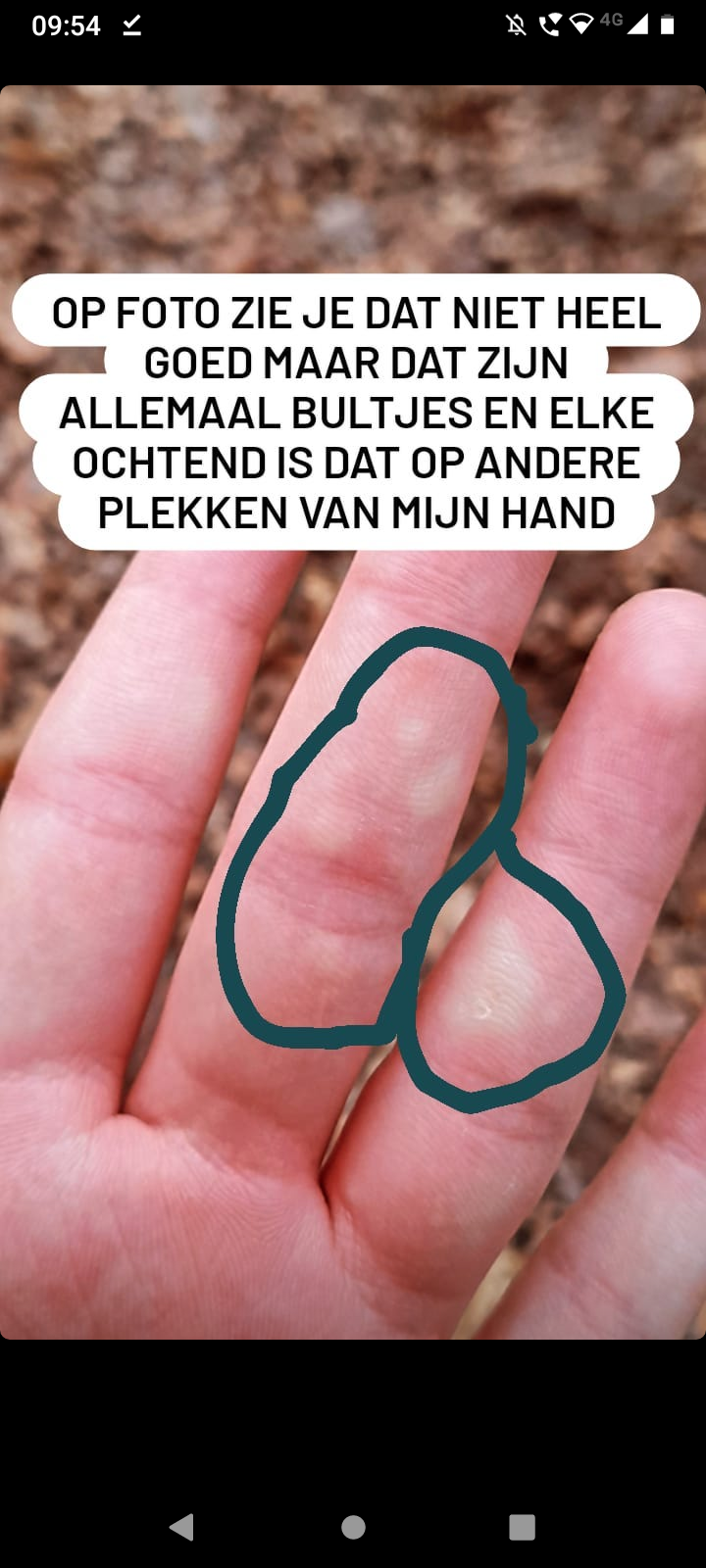 Weet iemand wat deze bultjes op mijn vingers zijn? Het jeukt ontzettend - GoeieVraag