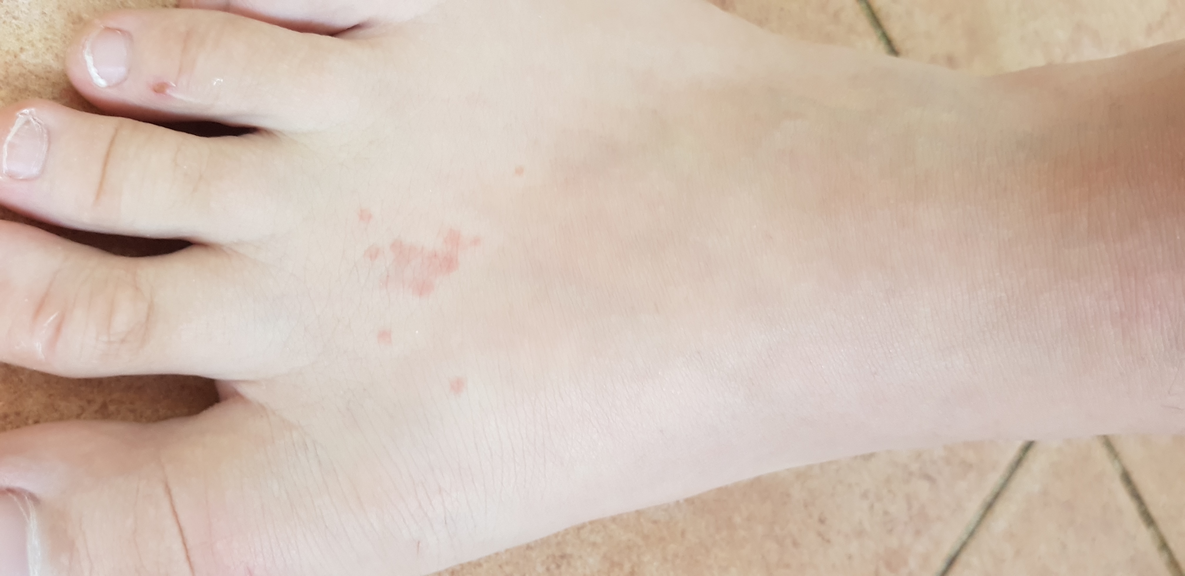 Wat is deze uitslag op mijn voet, zie foto? - GoeieVraag