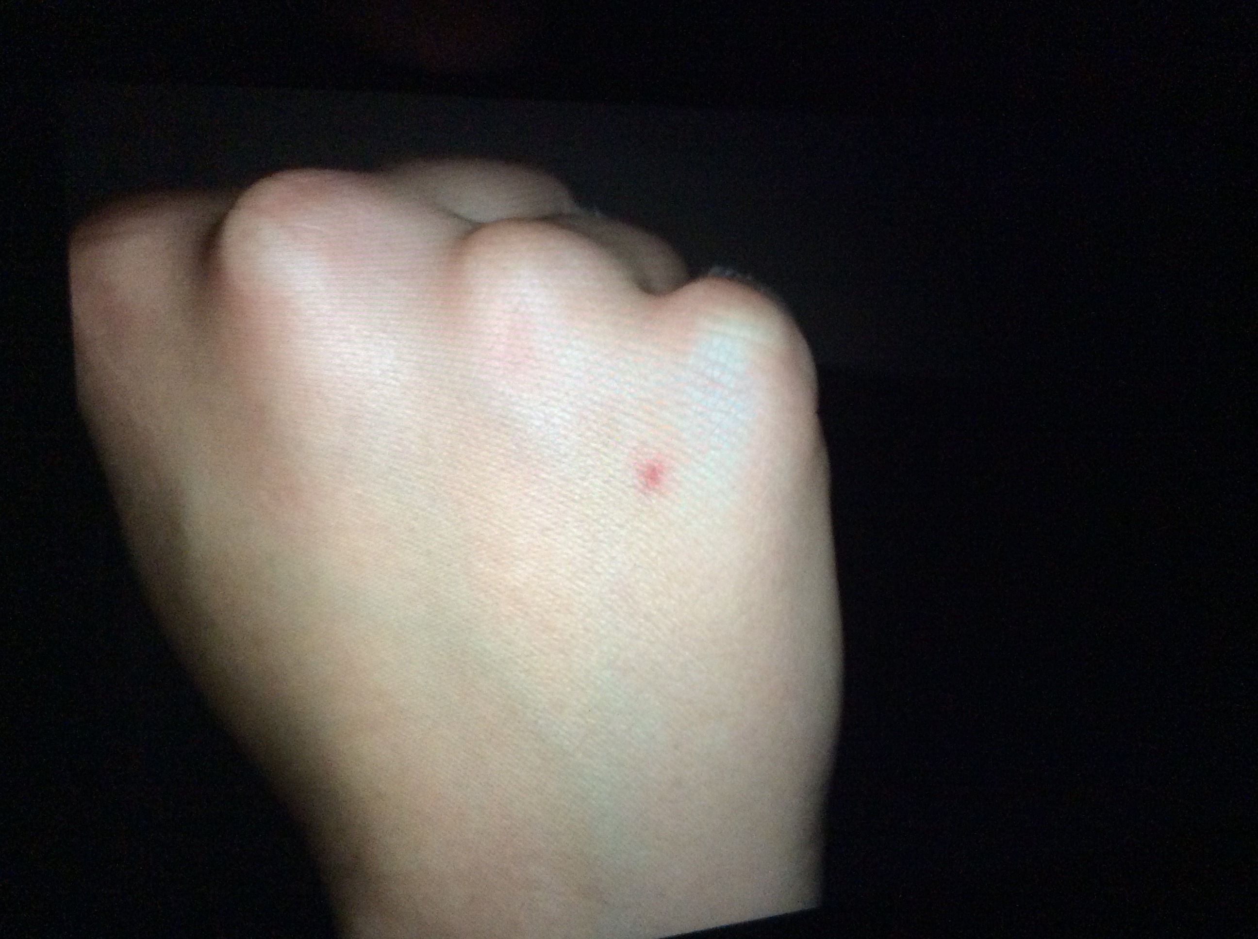 Heb ik een bloeduitstorting of is het iets anders? - GoeieVraag